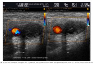 Deep Vein Thrombosis (DVT) – Dr. Sravan