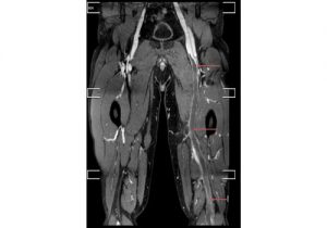 Deep Vein Thrombosis (DVT) – Dr. Sravan