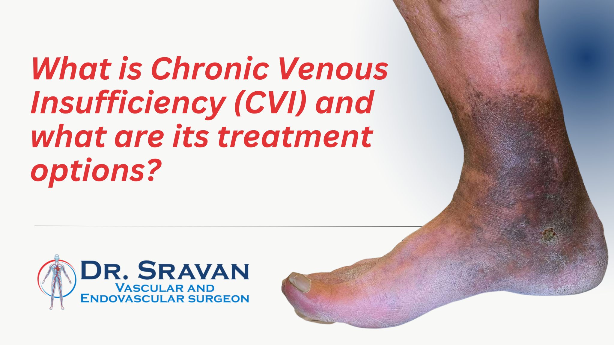 Chronic Venous Insufficiency | Causes, Symptoms & Treatment | Dr Sravan